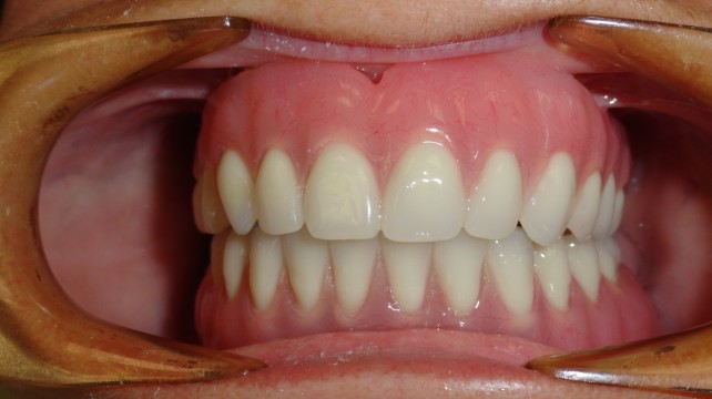 Free Dental Implant Seminars - Brian Jackson, DDS