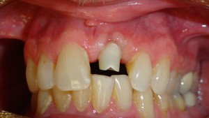 Free Dental Implant Seminars - Brian Jackson, DDS