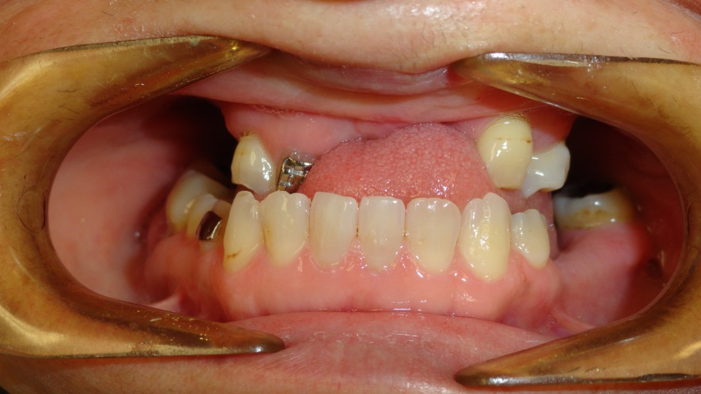 Free Dental Implant Seminars - Brian Jackson, DDS