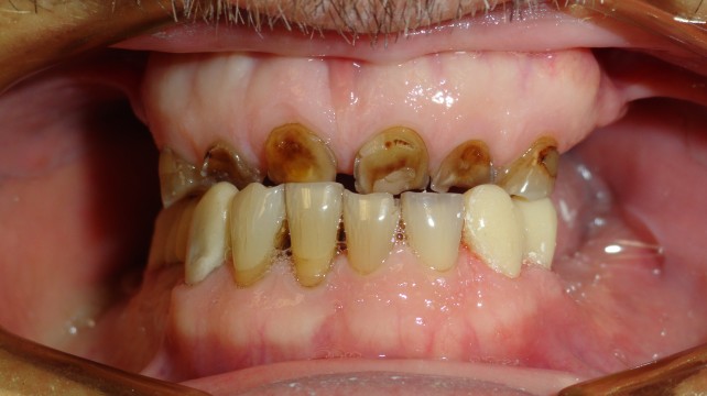 Free Dental Implant Seminars - Brian Jackson, DDS