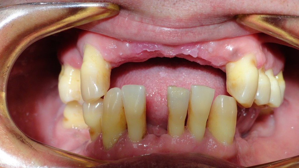 Free Dental Implant Seminars - Brian Jackson, DDS