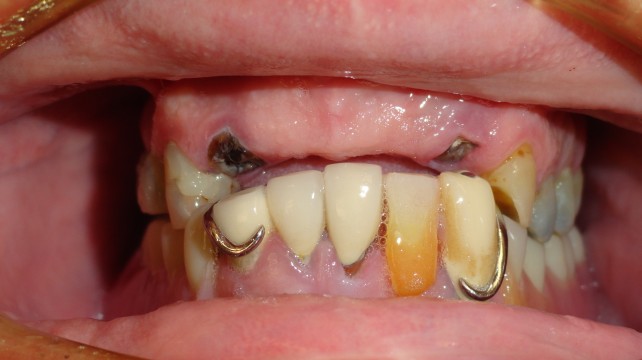 Free Dental Implant Seminars - Brian Jackson, DDS