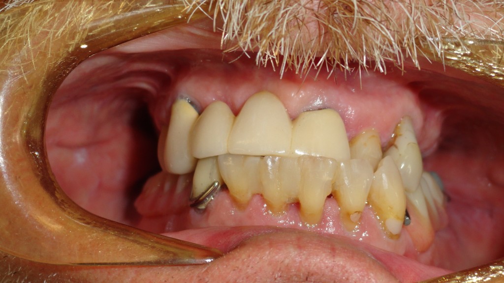 Free Dental Implant Seminars - Brian Jackson, DDS