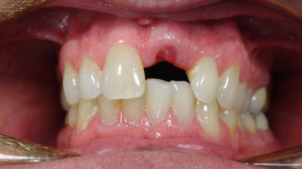 Free Dental Implant Seminars - Brian Jackson, DDS