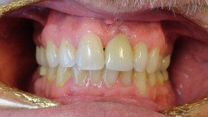 Free Dental Implant Seminars - Brian Jackson, DDS